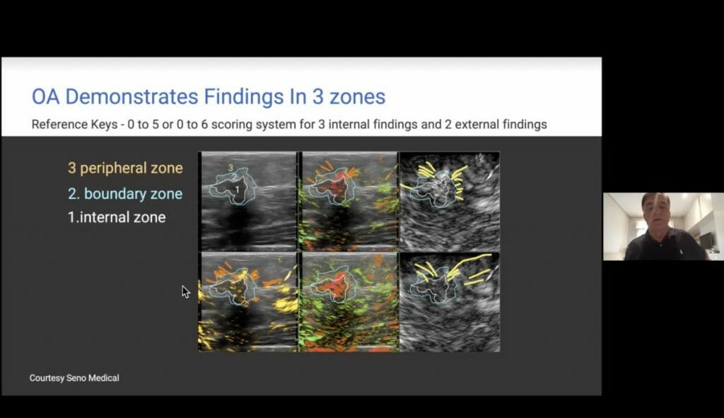 Opto-acoustics (OA/US): A New Hybrid Modality for Breast Cancer Diagnoses