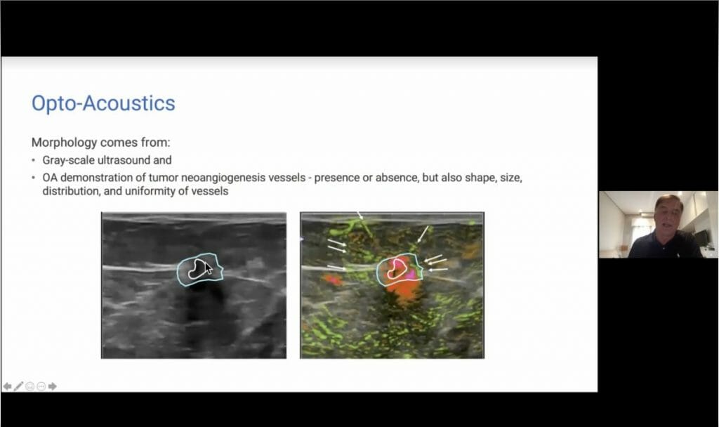Opto-acoustics (OA/US): A New Hybrid Modality for Breast Cancer Diagnoses