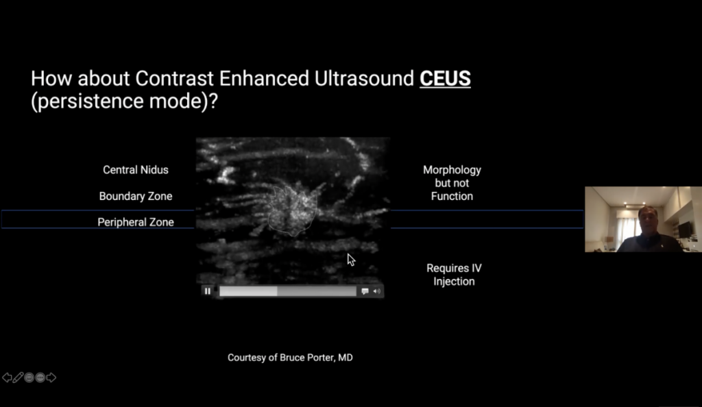 Opto-acoustics (OA/US): A New Hybrid Modality for Breast Cancer Diagnoses